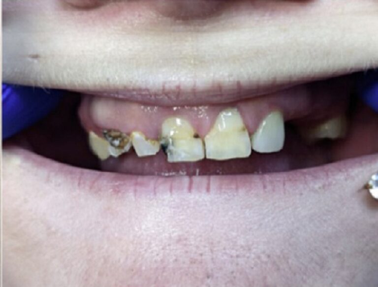 Everything You Need to Know About Tooth Resorption | ManiDental Family ...